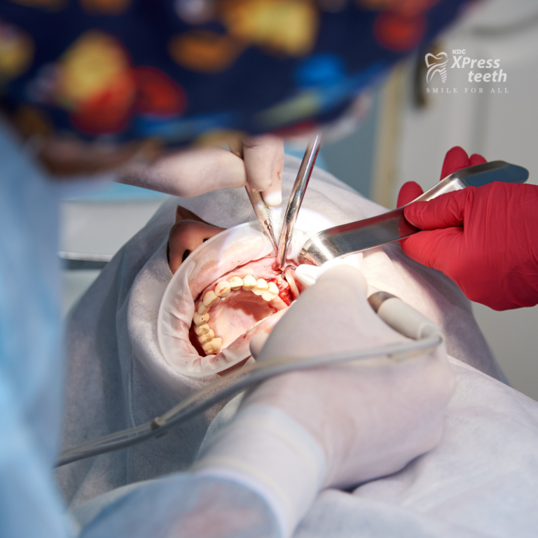Oral Surgery and Extractions - KDC Xpress Teeth