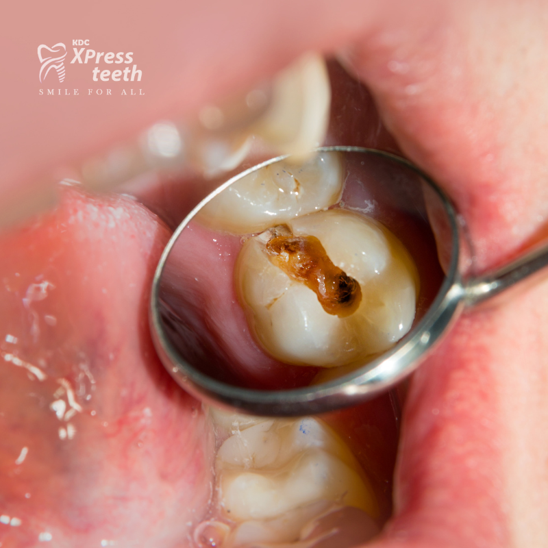 Dental fillings - KDC Xpress Teeth